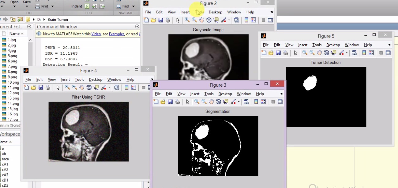Brain Tumor Detection And Classification Using Matlab Project Code ~ Matlab Projects 1505