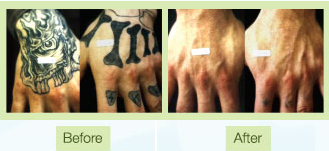 Erase Tattoo Removal: When People Change, Tattoos Change
