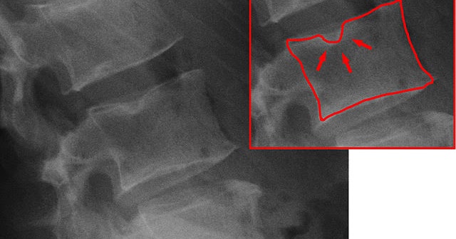 Natural Sports Medicine Blog: Back Pain - Car Accident & A Hidden ...