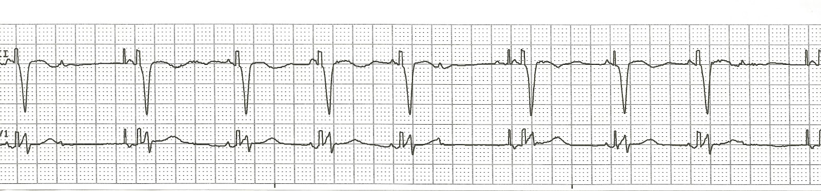 Practice EKG Rhythm Strips 95