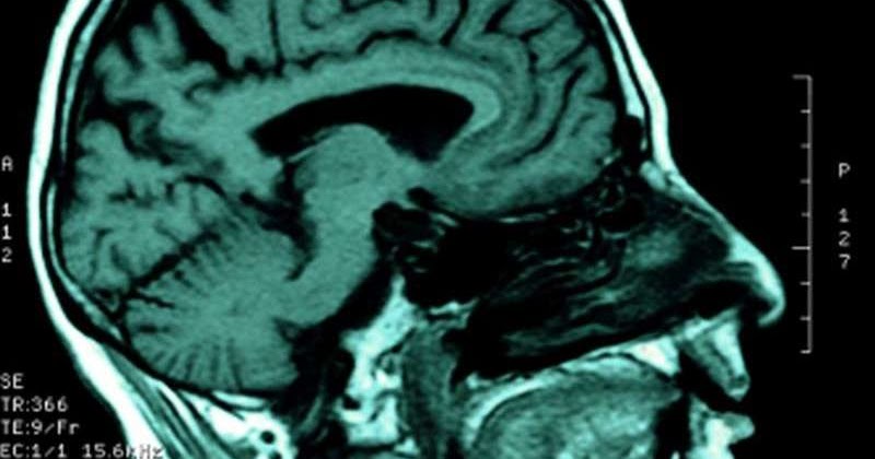 Our Parkinson's Place: Can brain 'pacemaker' improve lives of head ...