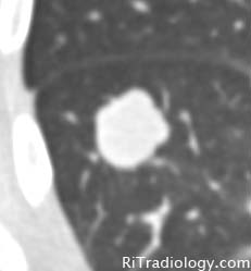 RiT radiology: Solitary Pulmonary Nodule: Definition, DDx, and ...