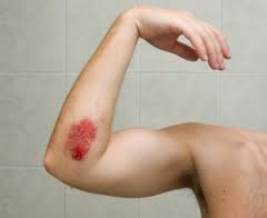 Actuación ante contusiones - Seguridad y Salud en el Trabajo