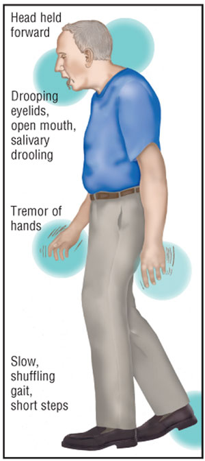Our Parkinson's Place: In PD, Difficulty Walking May Be Due to Impaired ...