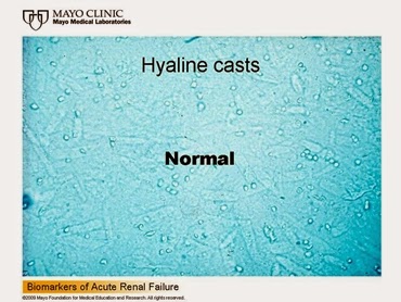 USMLE COMLEX Study Guides : Renal Pathology: Glomerular Diseases