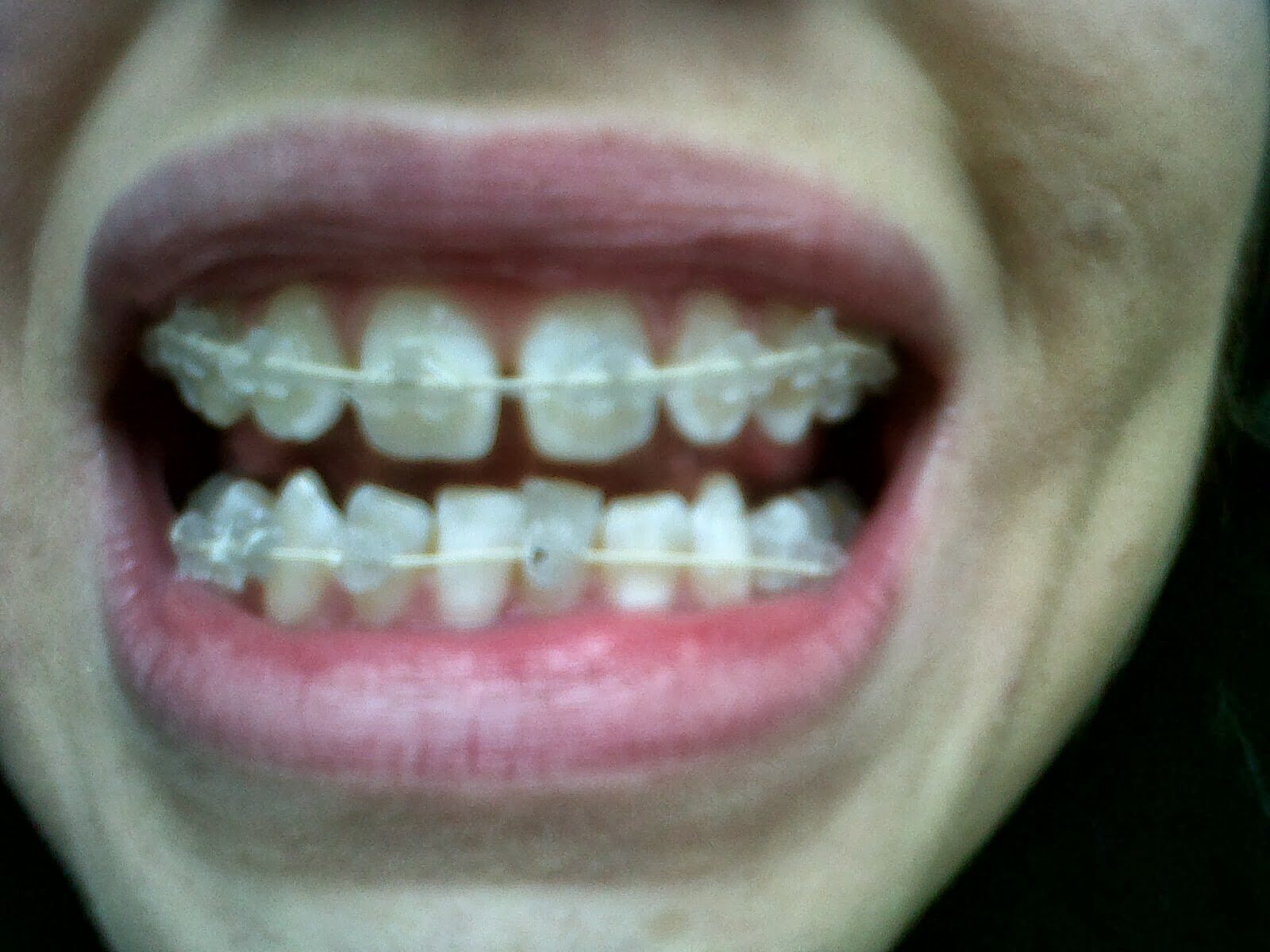 My FastBraces