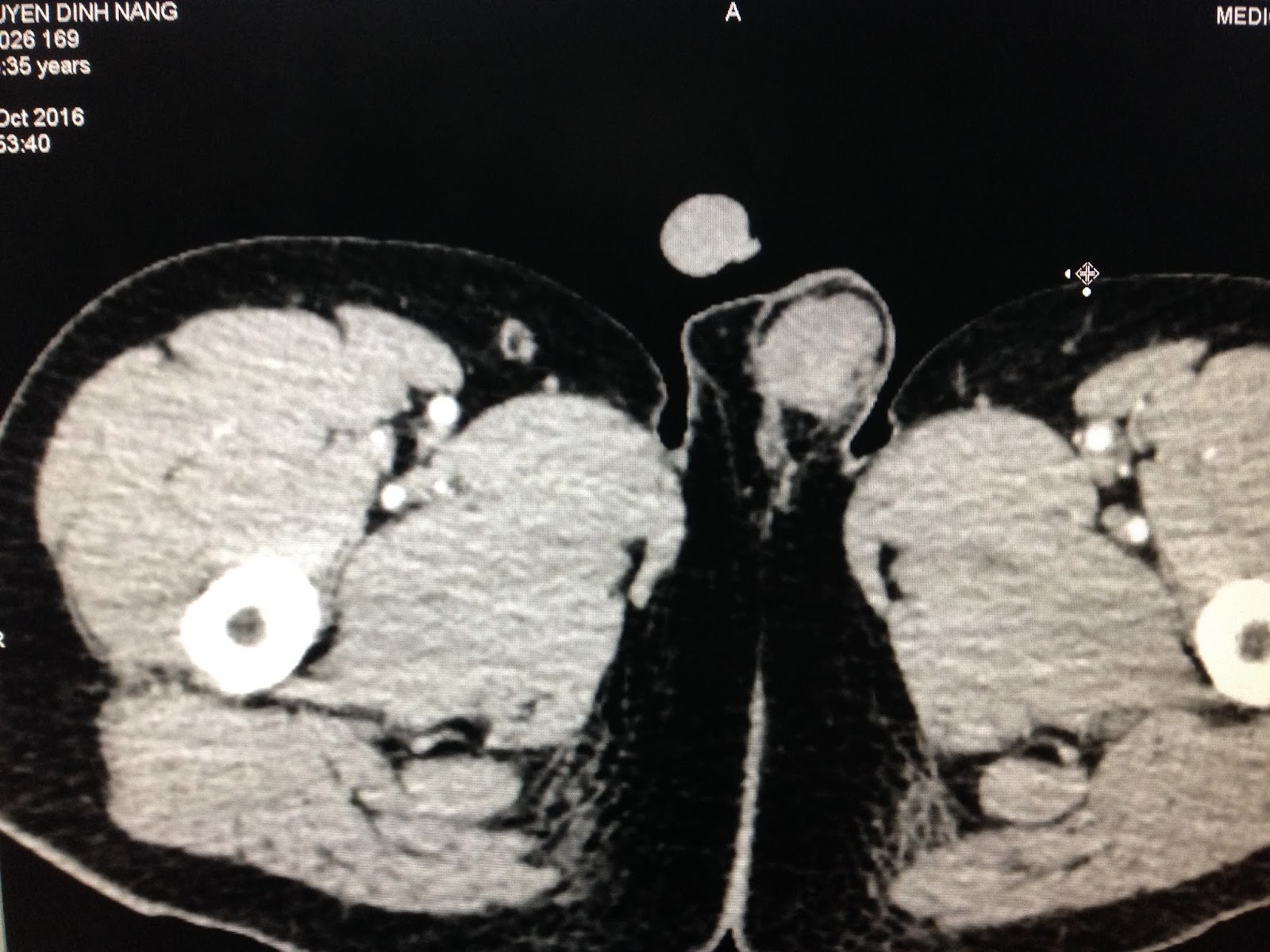VIETNAMESE MEDIC ULTRASOUND: November 2016