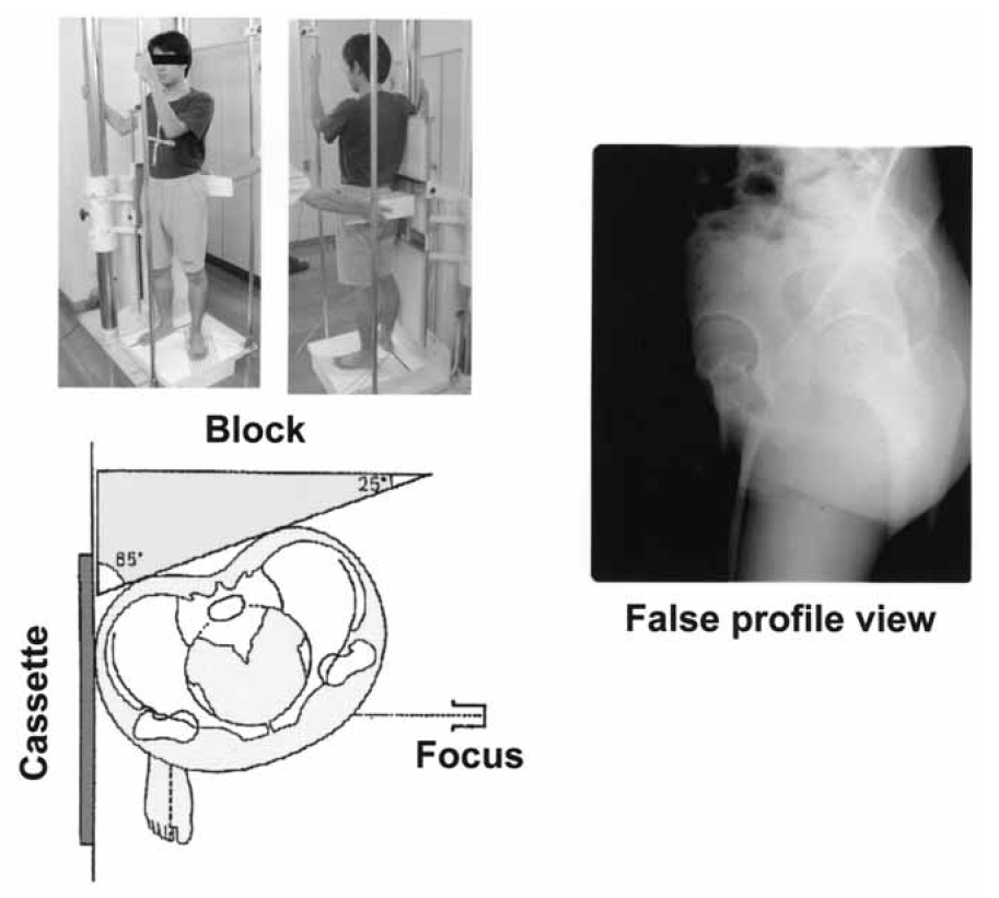 肩関節・肘関節・手関節・膝関節・股関節・足関節・脊椎・スポーツ 運動器リハビリテーション OH!NO!DX BLOG: 股関節前方被覆を確認 ...