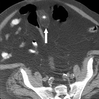 ABC Radiology Blog: The Ring Sign