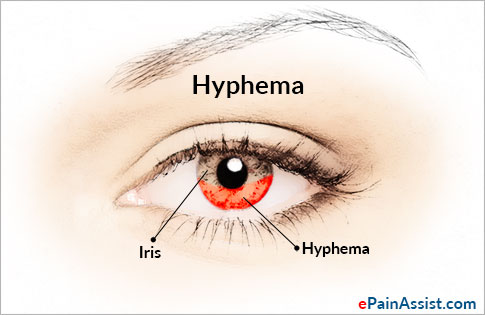 Contoh Askep HIFEMA | Blog Kesehatan