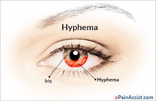 Contoh Askep HIFEMA | Blog Kesehatan