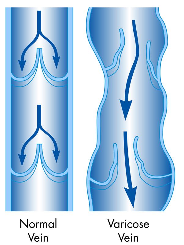 Secrets of Mom: Varicose Vein Surgery