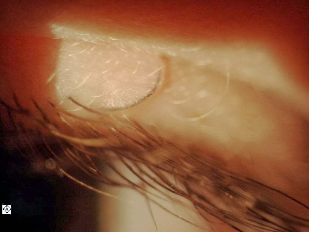 Sonoran Desert Eye Center: INGROWN EYELASH