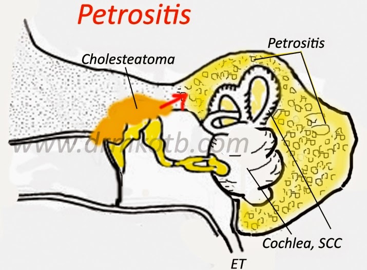 Patologías del Oído: Patologias oido medio
