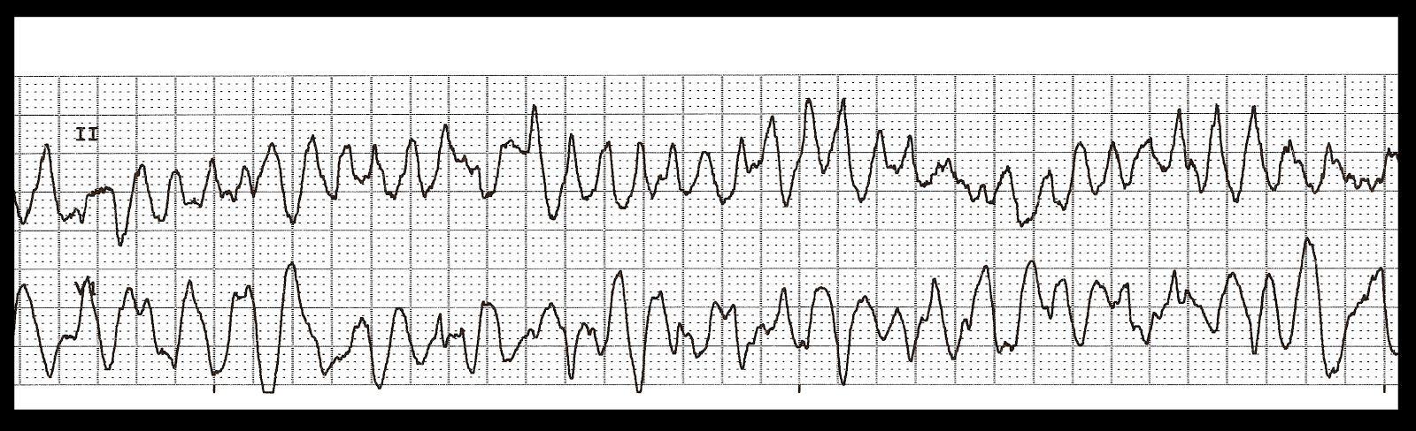 Ventricular rhythm Quiz 294