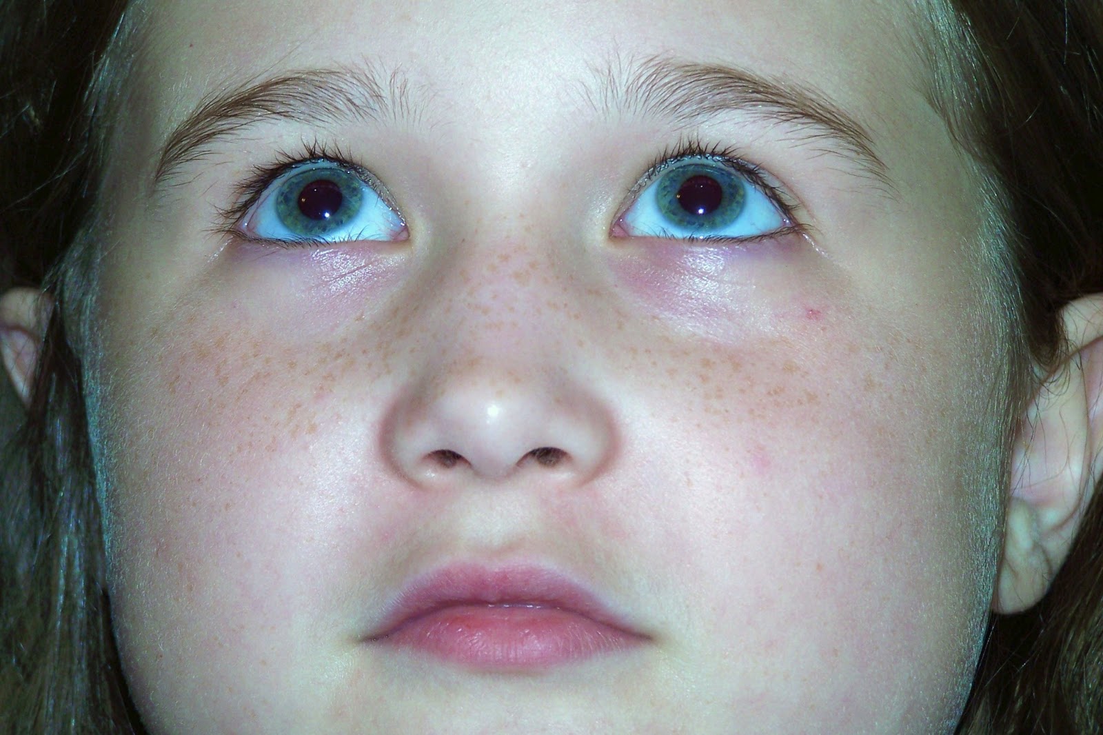 Beyond the Mirror: What Cold Induced Urticaria Looks Like