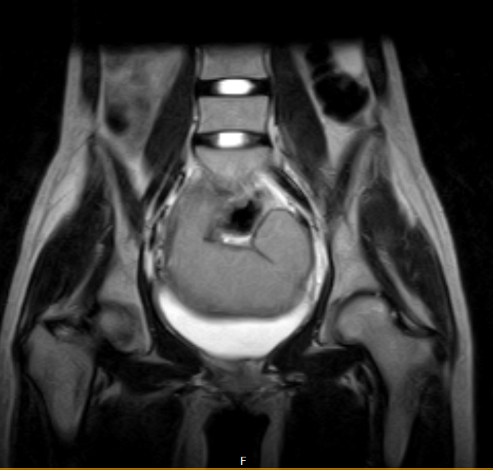 Haematometra & Hematosalpix-MRI - Sumer's Radiology Blog