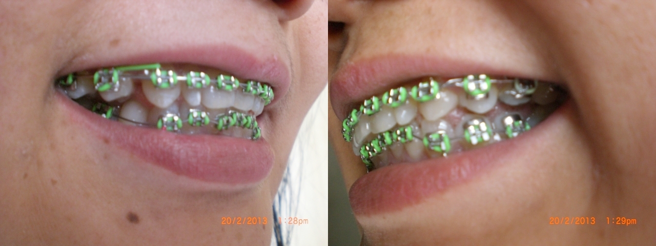 My Braces Elicy: Fixing bracket at bottom teeth