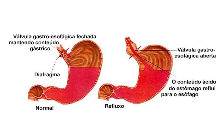 KCA: Exame de Refluxo