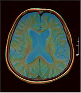 Nevit's blog: False-color Brain MRI (Motion artifacts)