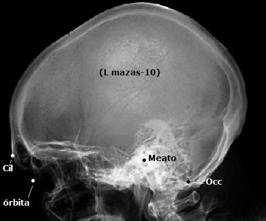 El Baúl Radiológico: LÍNEA MEATO-ORBITARIA (Orbitomeatal Line) by luis ...
