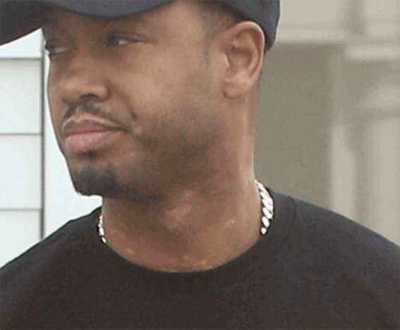 Terrence Jenkins Vitíligo