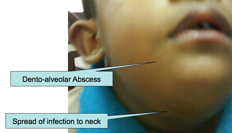 UOP FDS 2007 Batch Oral Surgery E-Learning Blog: Spread of Odontogenic ...