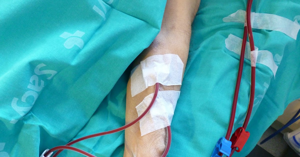 Nefrología para todos: ¿Qué hacer si la fístula de diálisis empieza a ...