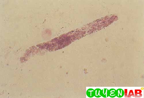 Atlas of Casts in urine | Free Medical Atlas