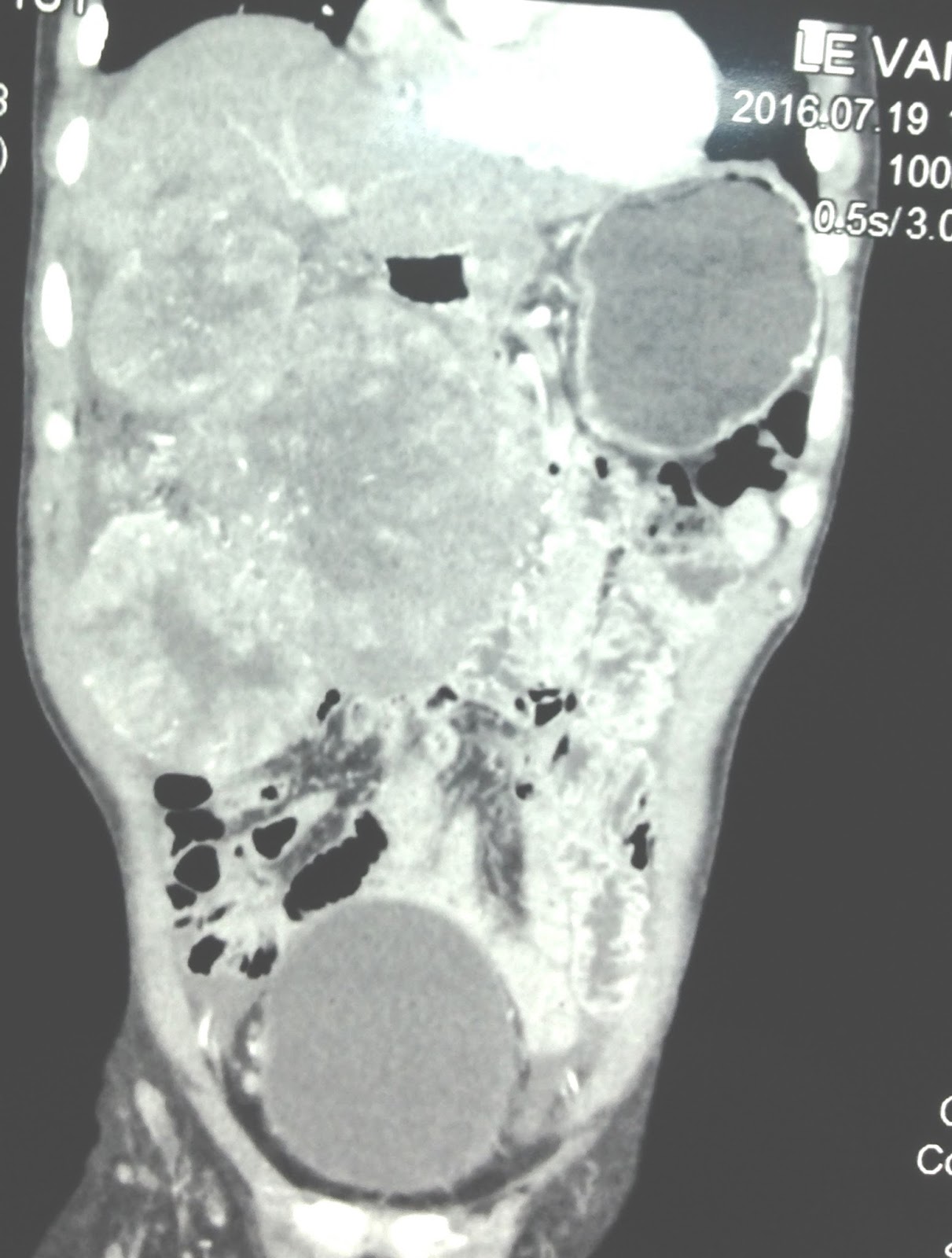 VIETNAMESE MEDIC ULTRASOUND: CASE 390: PEDUNCULATED HCC, Dr PHAN THANH ...