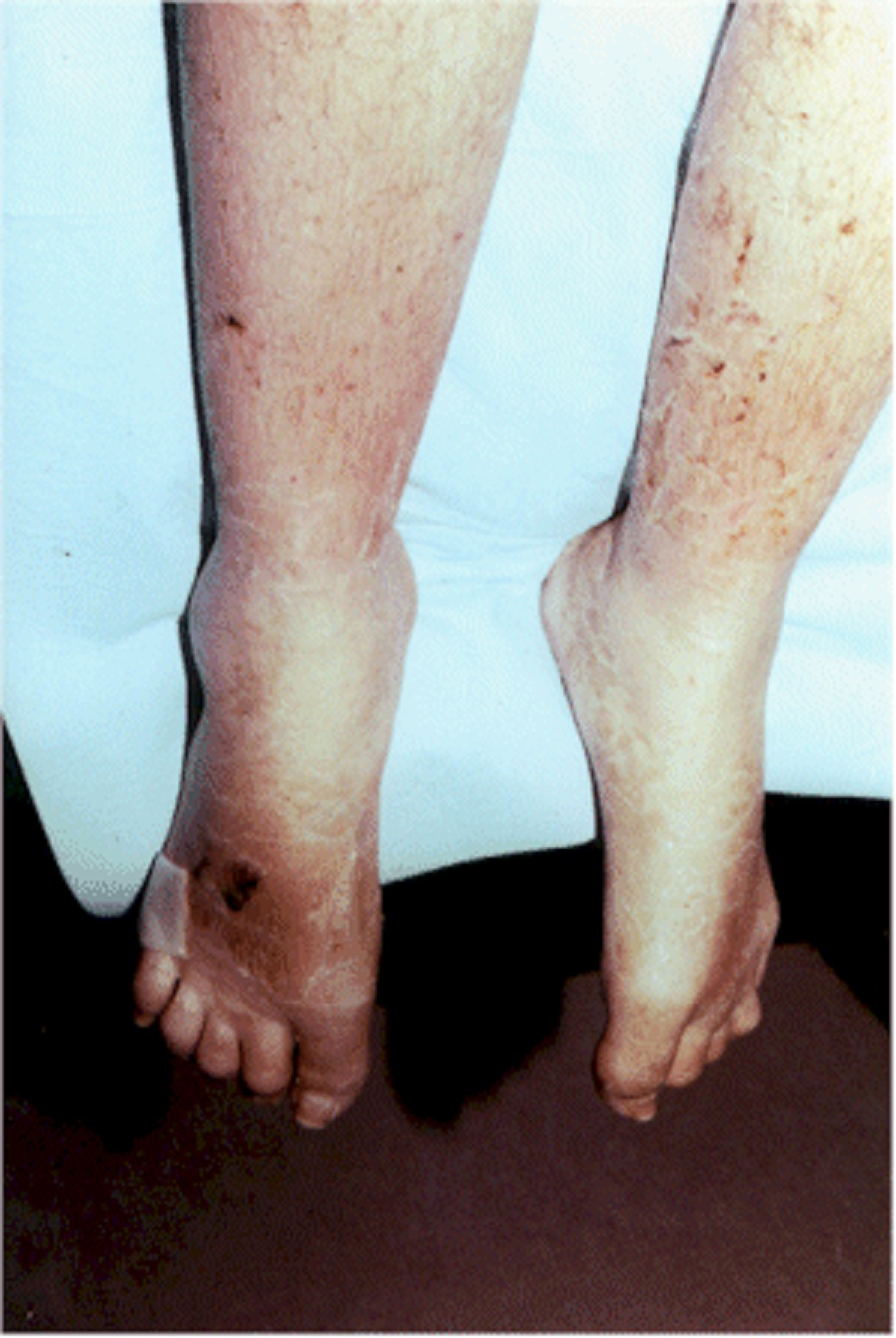 Complex Regional Pain Syndrome:This is MY life, doc!: SIGNS AND ...