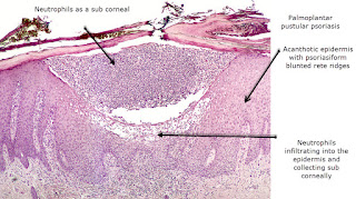 Dermatopathology Made Simple - Inflammatory: Pustular Reaction Pattern