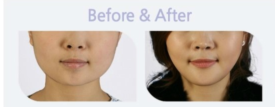 BK Plastic Surgery: [BK Plastic Surgery] How to have slender face