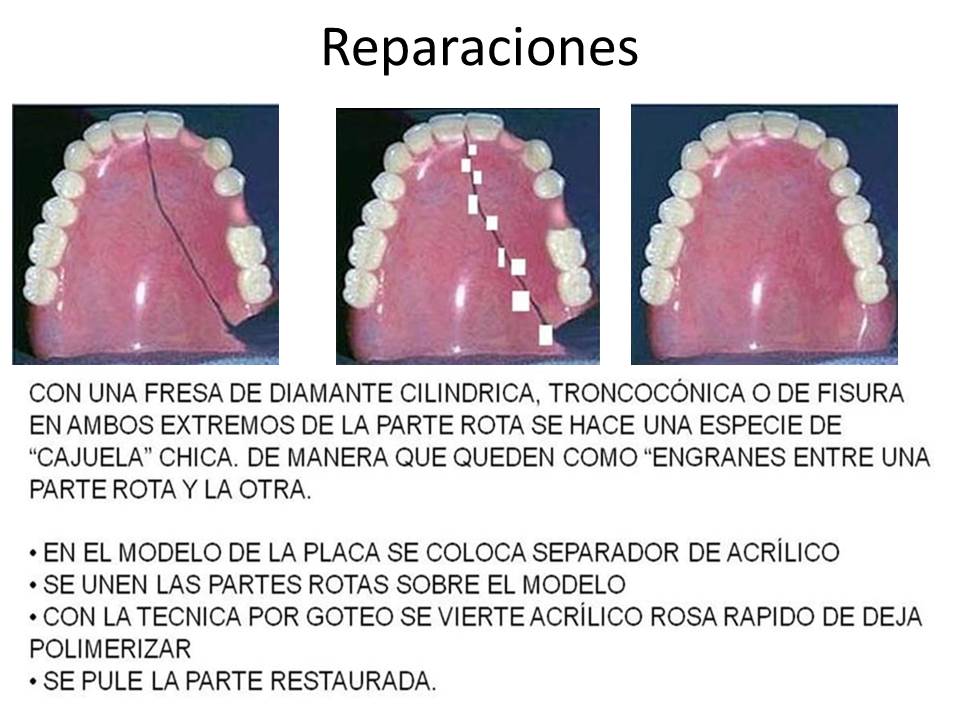 Verano Rehabilitación III: 2° Parcial Procesado de la Placa Total
