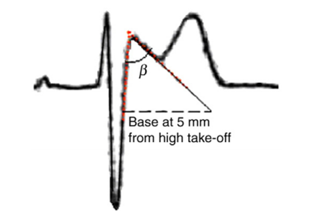 Dr. Smith's ECG Blog: Is this Type 2 Brugada syndrome/ECG pattern?