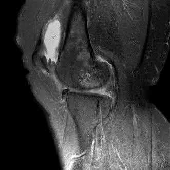 MRI Knee Joint edema joint effusion ON suprapatellar bursae and ...