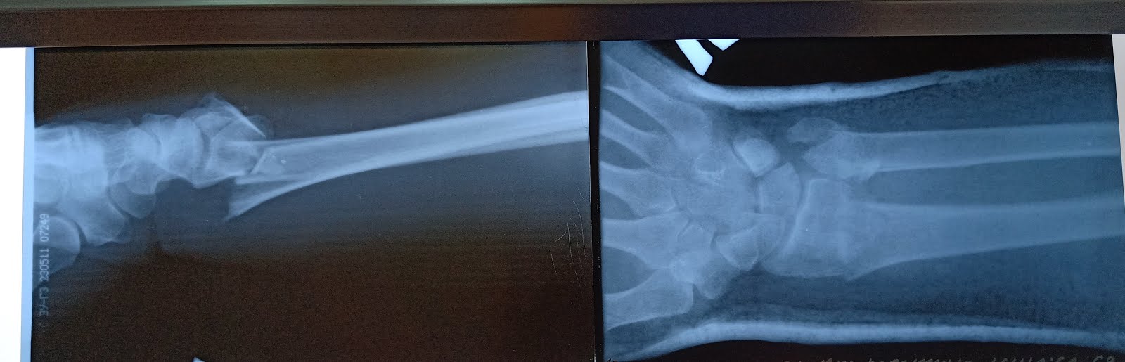 CASE PRESENTATION OF TYPE COLLES’ FRACTURE