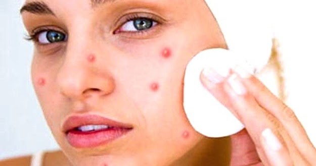 How To Remove Pimples? Natural Ways To Get Rid Of Them Easily | Skin ...