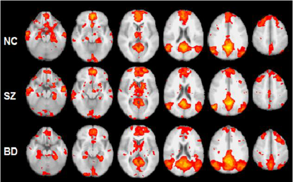 MRI and Medical Imaging: fMRI of brain at rest reveals early signs of ...