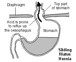 What is Hiatal Hernia