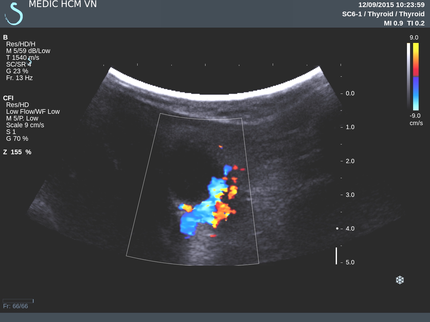 VIETNAMESE MEDIC ULTRASOUND: CASE 333: LUNG MASS, Dr PHAN THANH HẢI ...