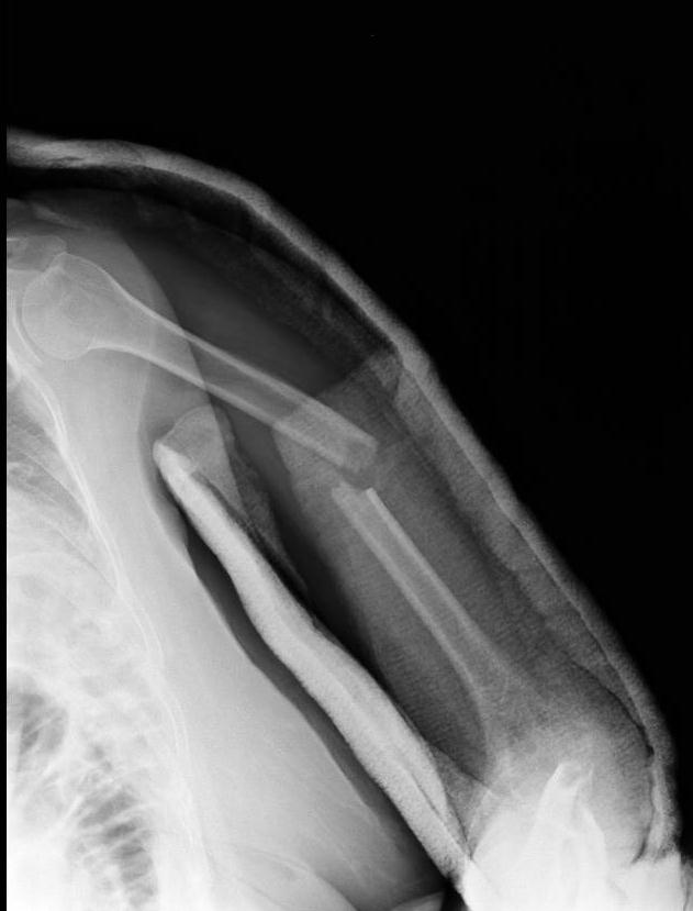 O R T O C R I T I C A: Fractura diafisiaria de humero
