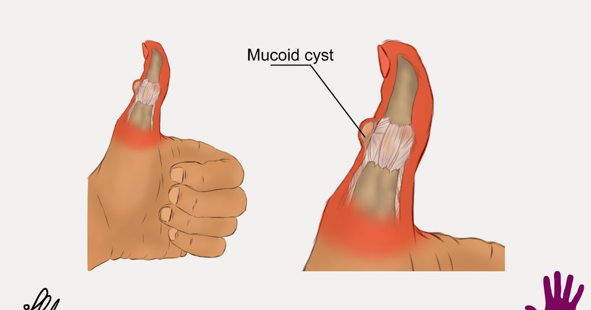 Wide Awake Hand Surgeon In London: One Stop Wide Awake Hand Surgery ...