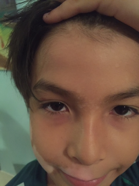 VIRTUAL GRAND ROUNDS IN DERMATOLOGY 2.0: Unilateral/Segmental Vitiligo ...