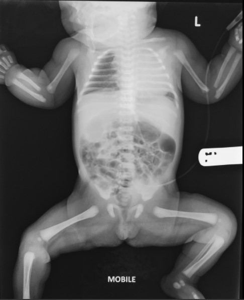 Teknik Radiografi: Teknik Radiografi Babygram