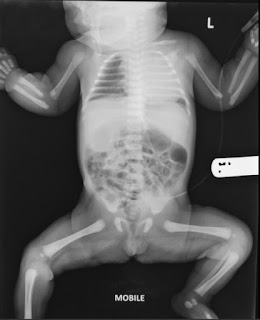 Teknik Radiografi: Teknik Radiografi Babygram