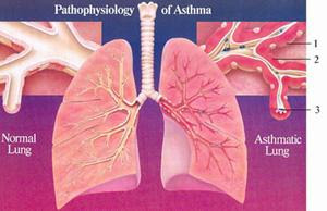 Pathophysiology of Asthma - Understand for Prevention - How To Treat ...
