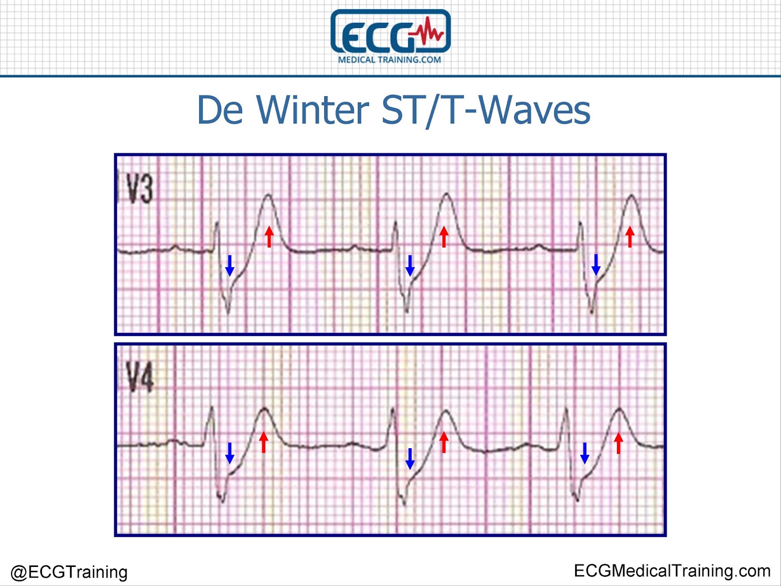 Medical English - Medical Informations: De Winter ST/T-Waves: Dấu De Winter