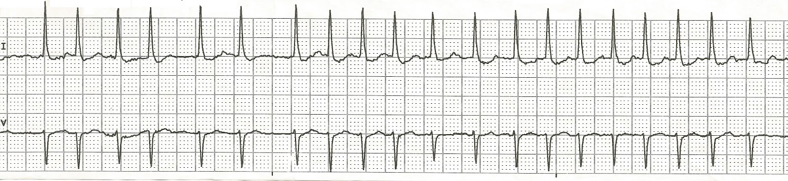 EKG Rhythm Strip Quiz 74
