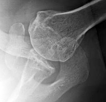 UW Shoulder and Elbow Academy: Ream and run - posteriorly eccentric ...